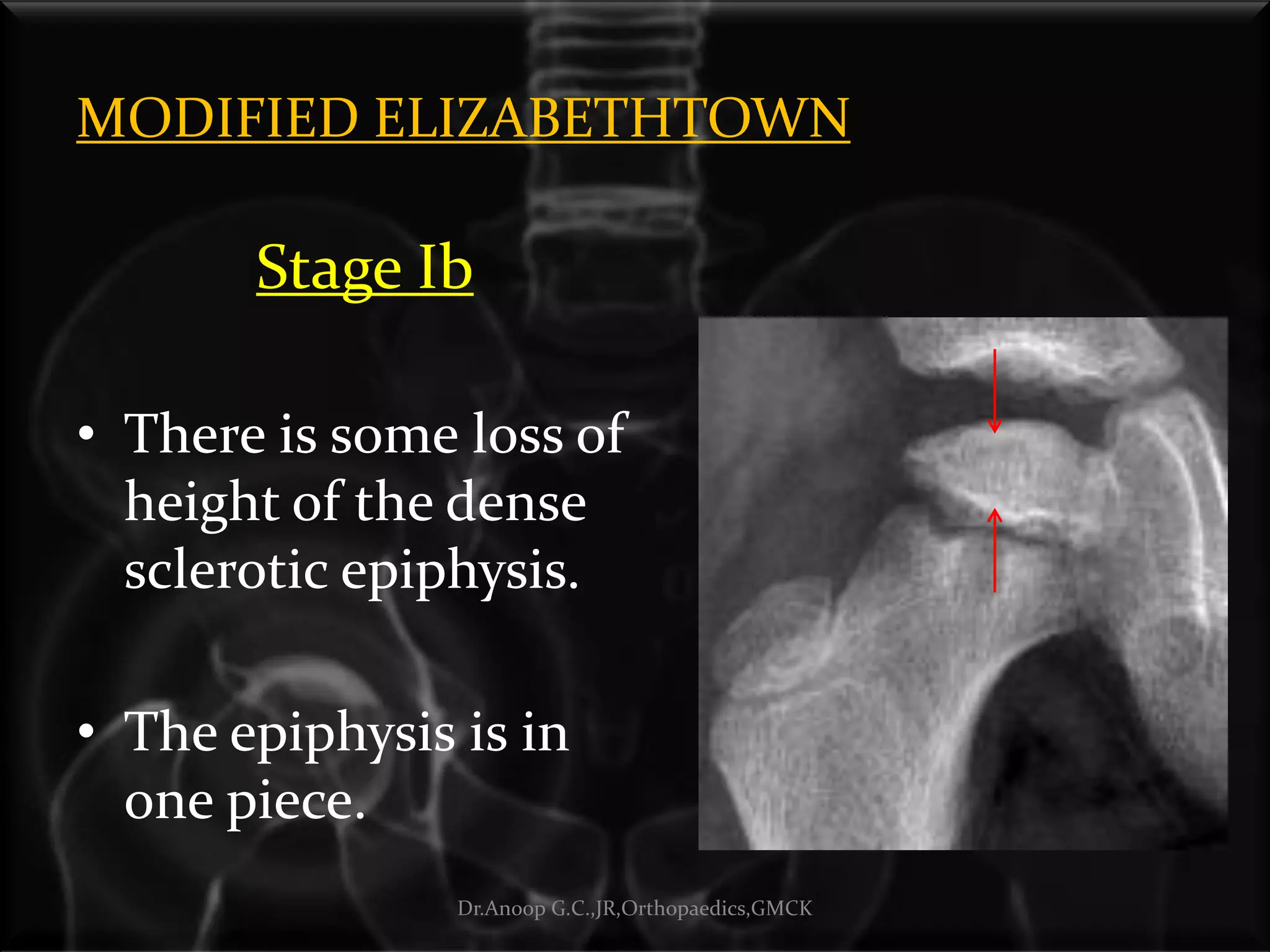 Classification perthes Disease | PDF