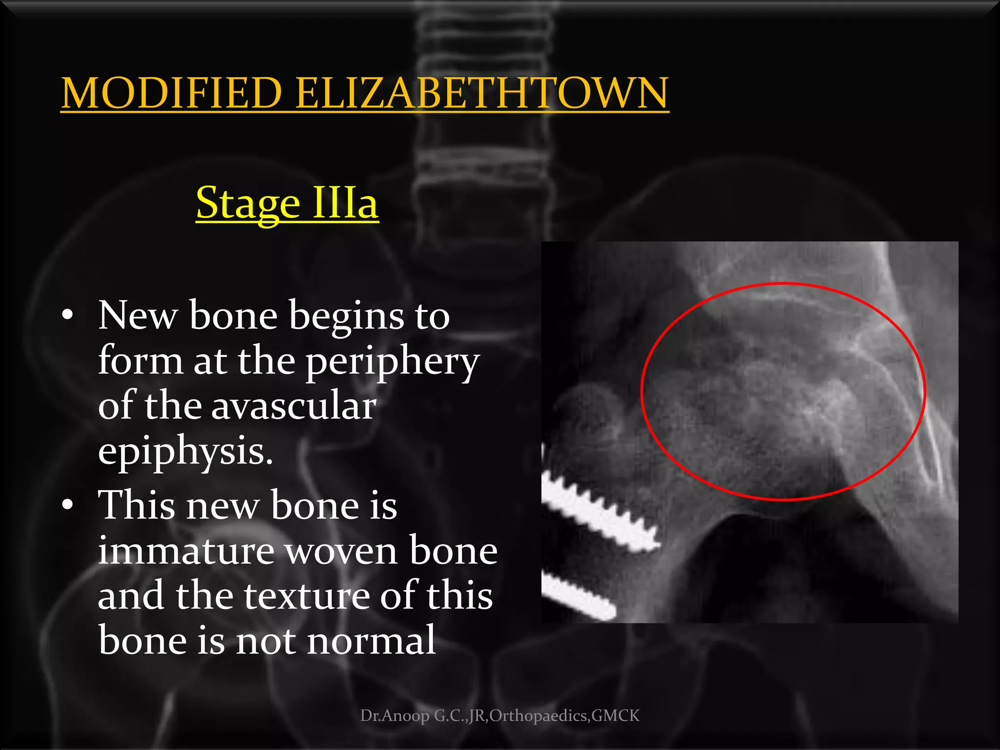 Classification perthes Disease | PDF