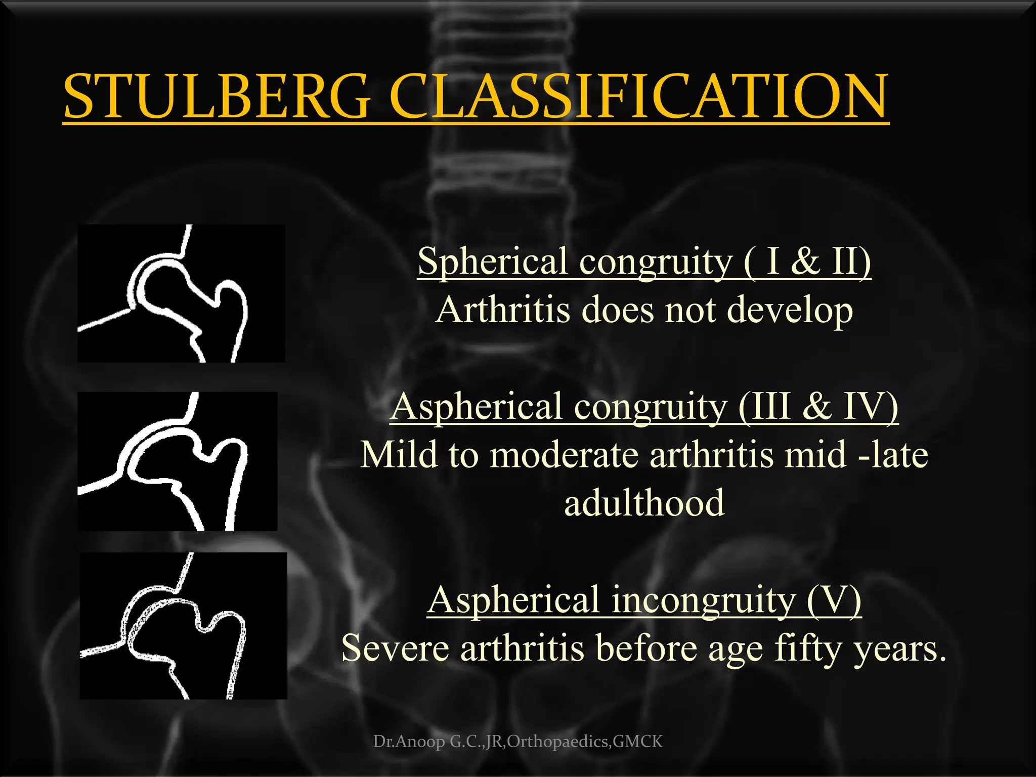 Classification perthes Disease | PDF