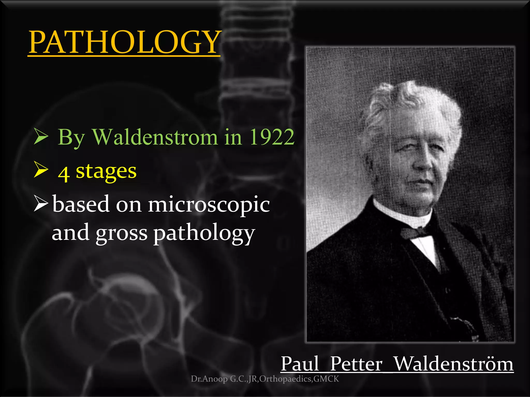 Classification perthes Disease | PDF