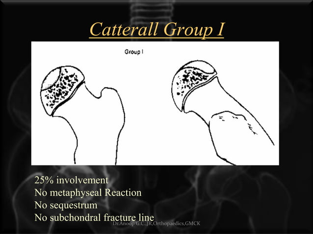 Classification perthes Disease | PDF