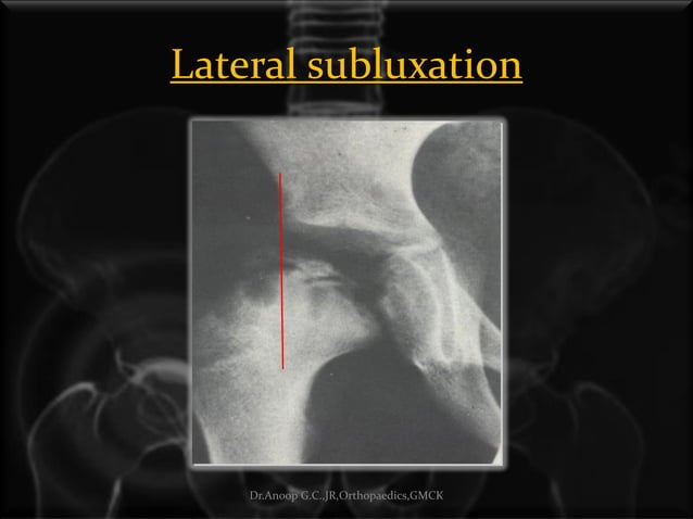 Classification perthes Disease | PDF