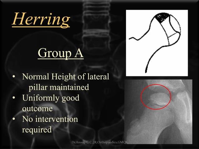 Classification perthes Disease | PDF
