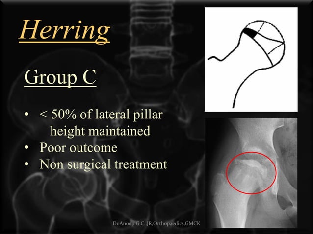 Classification perthes Disease | PDF