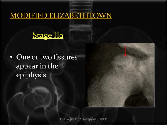 Classification perthes Disease | PDF