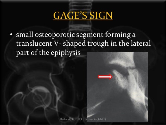 Classification perthes Disease