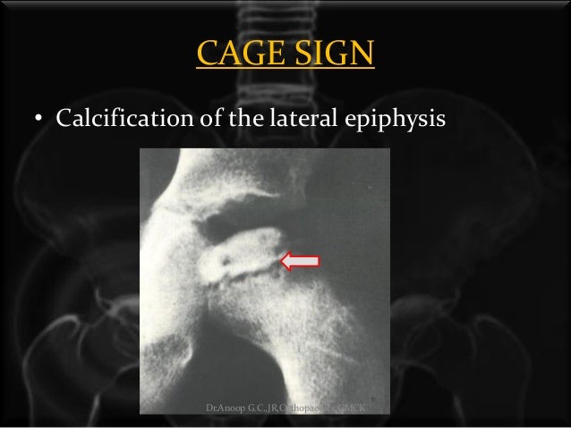 Classification perthes Disease