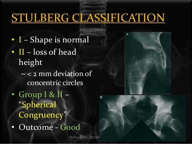 Classification perthes Disease