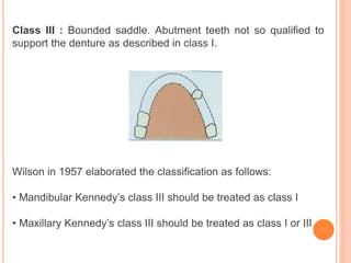 classification RPD.pptx