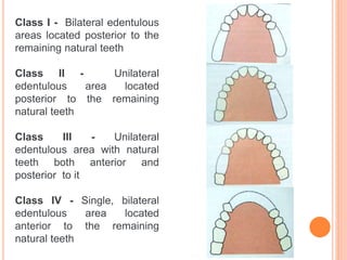 classification RPD.pptx