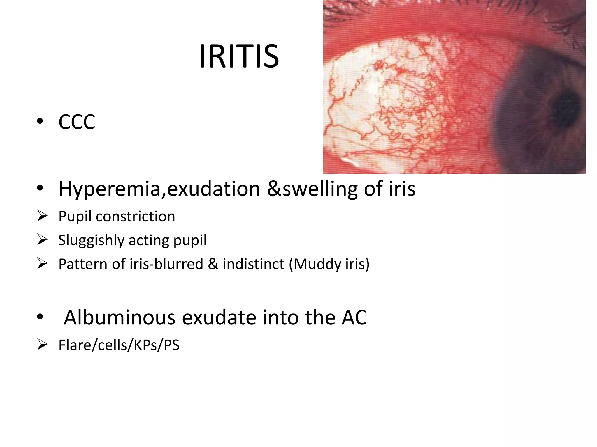Classifications of etio pathogenesis of ueitis, anterior uieitis-dr.k ...
