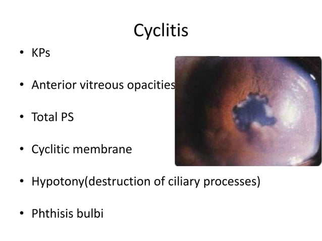 Classifications of etio pathogenesis of ueitis, anterior uieitis-dr.k ...