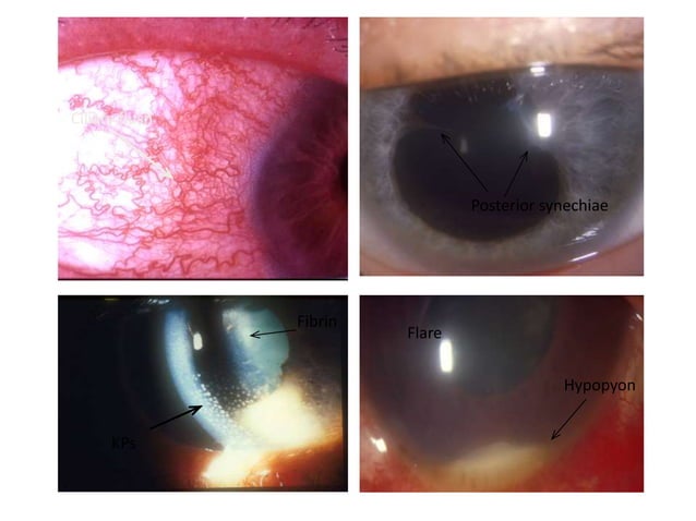 Classifications of etio pathogenesis of ueitis, anterior uieitis-dr.k ...