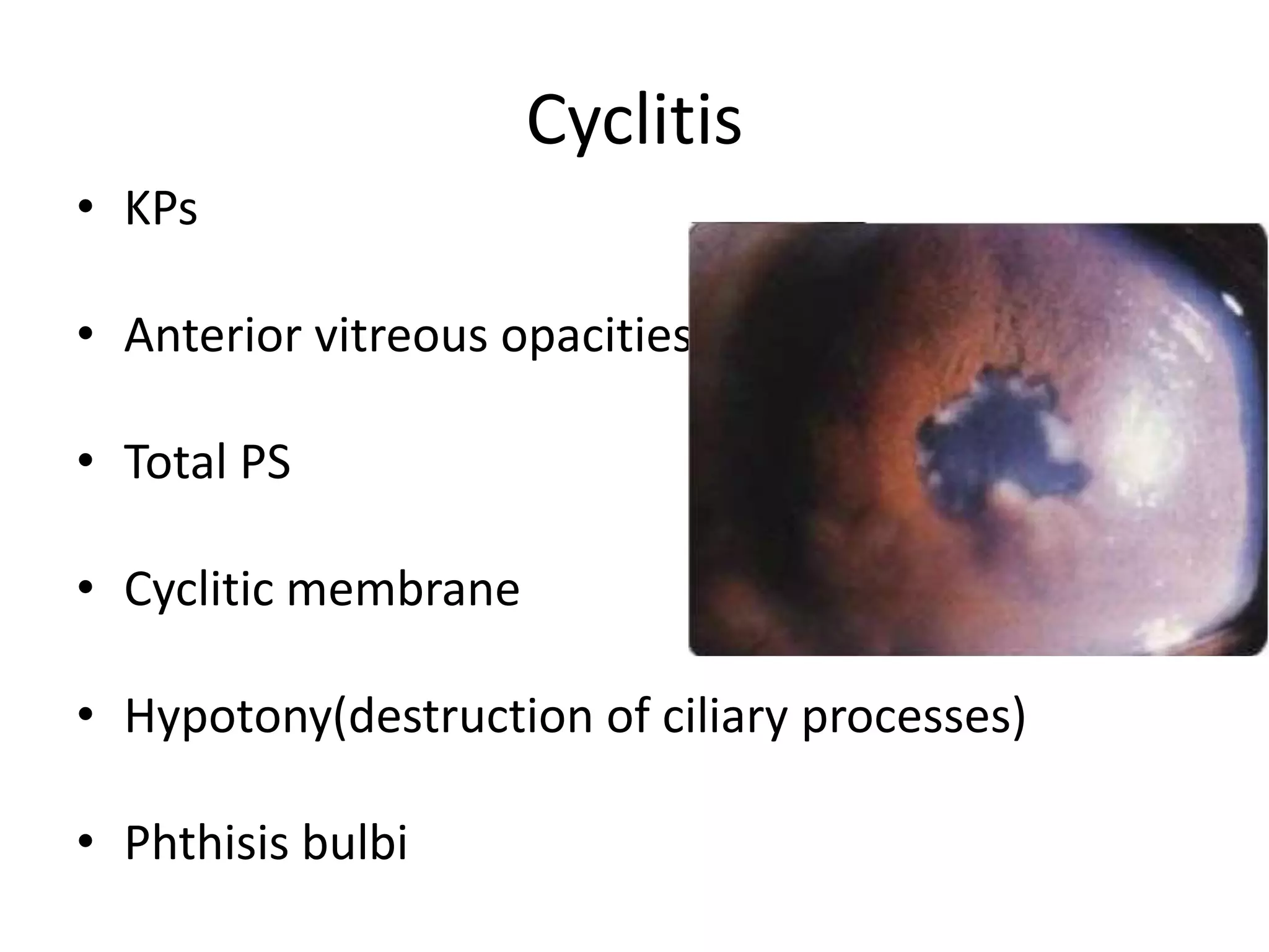 Classifications of etio pathogenesis of ueitis, anterior uieitis-dr.k ...