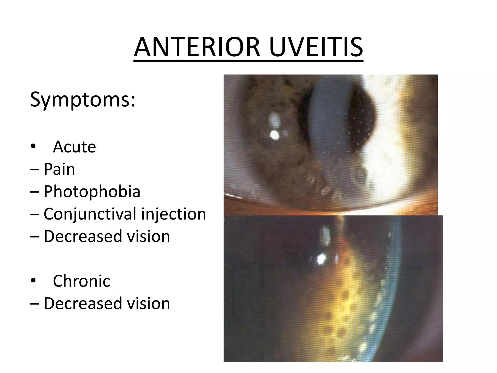 Classifications of etio pathogenesis of uveitis, anterior uveitis- dr.k ...