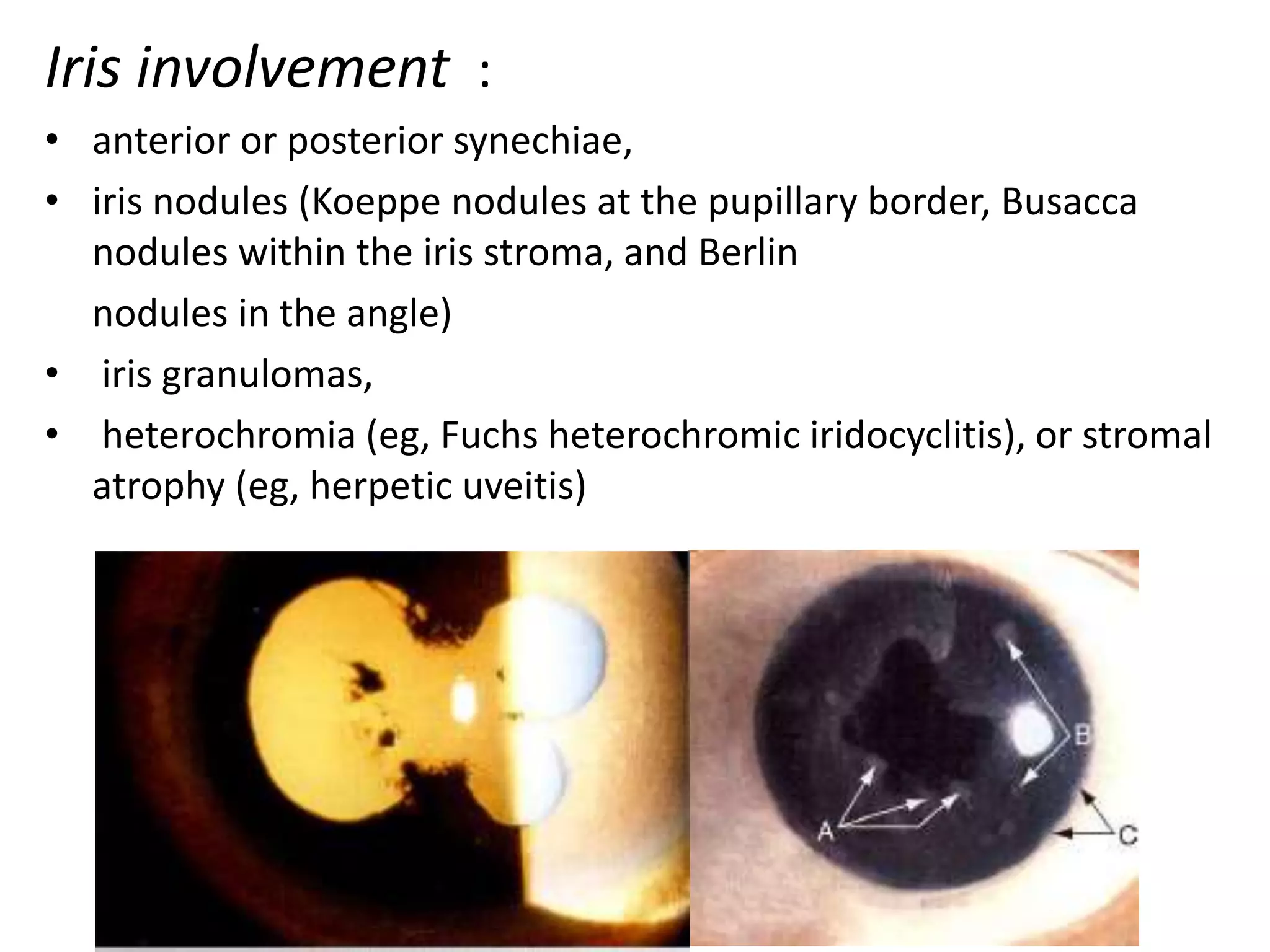 Classifications of etio pathogenesis of uveitis, anterior uveitis- dr.k ...