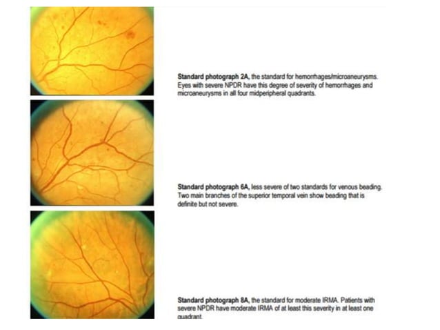 Classification Staging Grading in Ophthalmology | PPTX