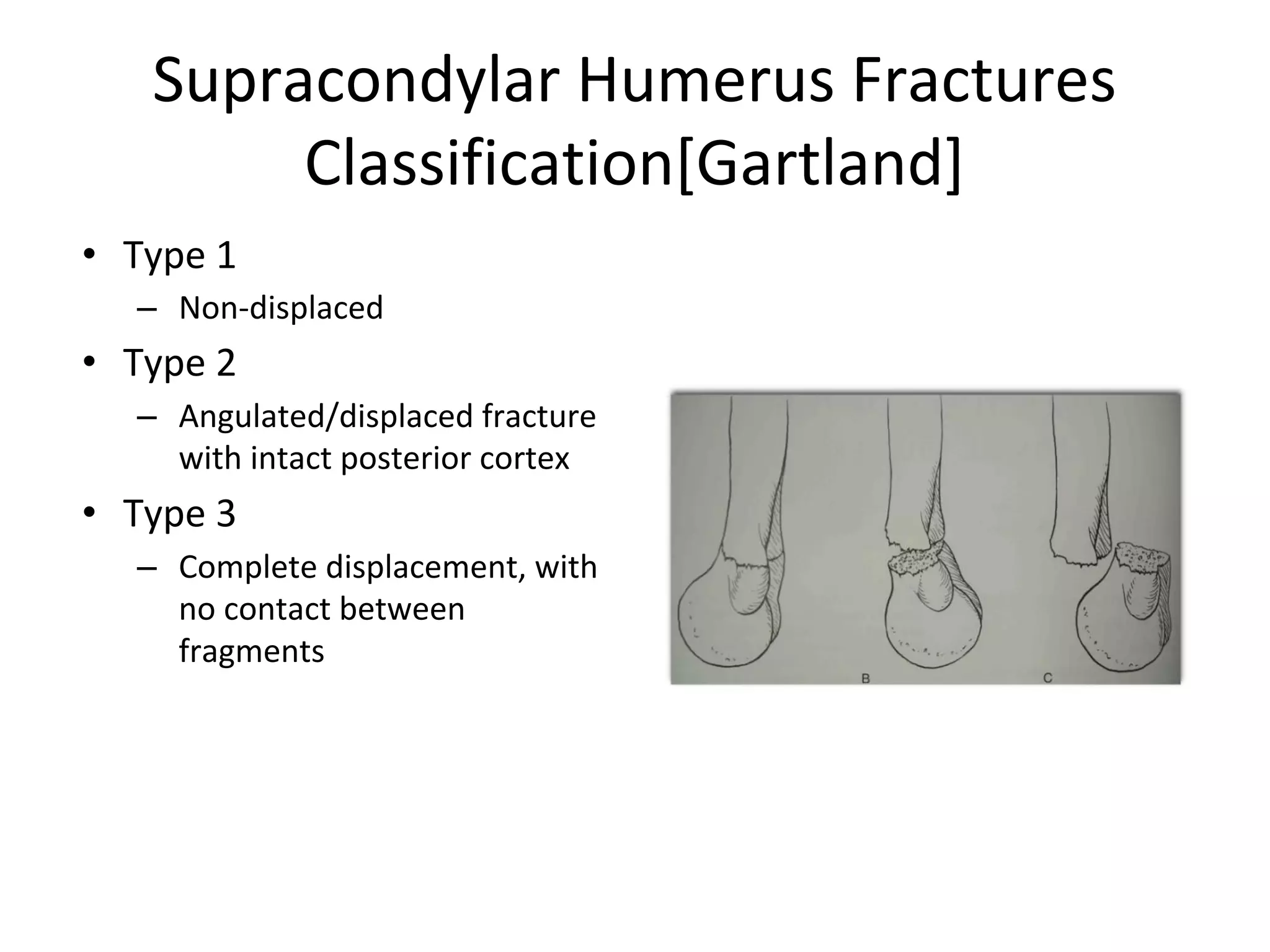 Classificaton-of-injuries-around-elbow-management-of-supracondylar ...