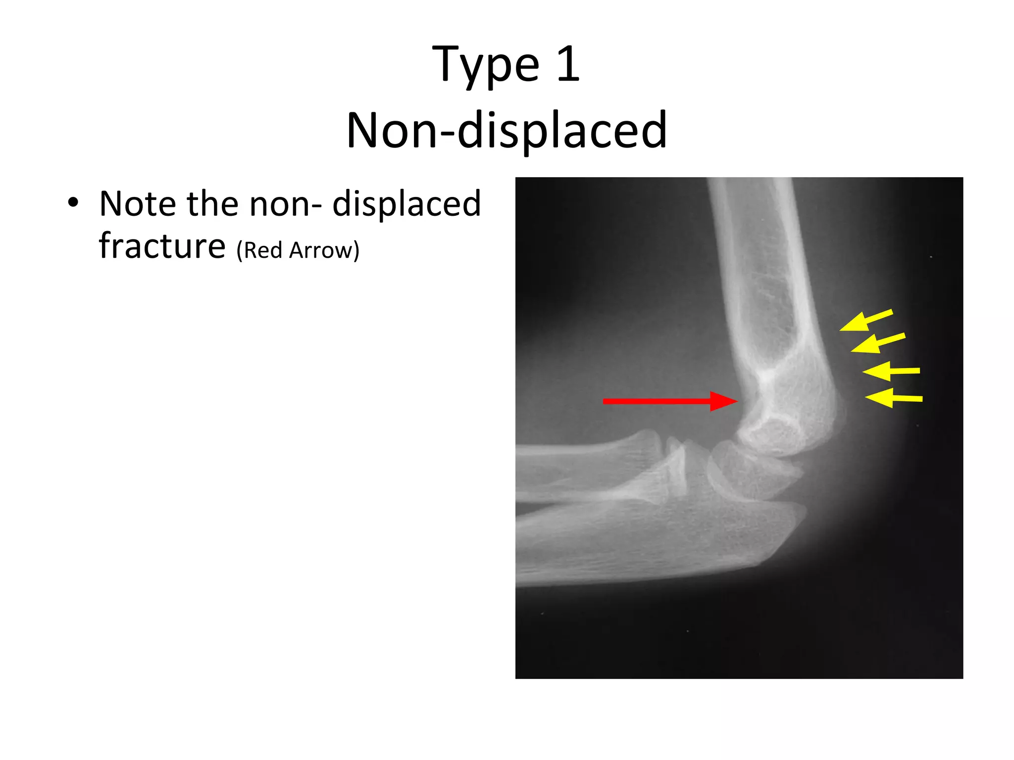Classificaton-of-injuries-around-elbow-management-of-supracondylar ...