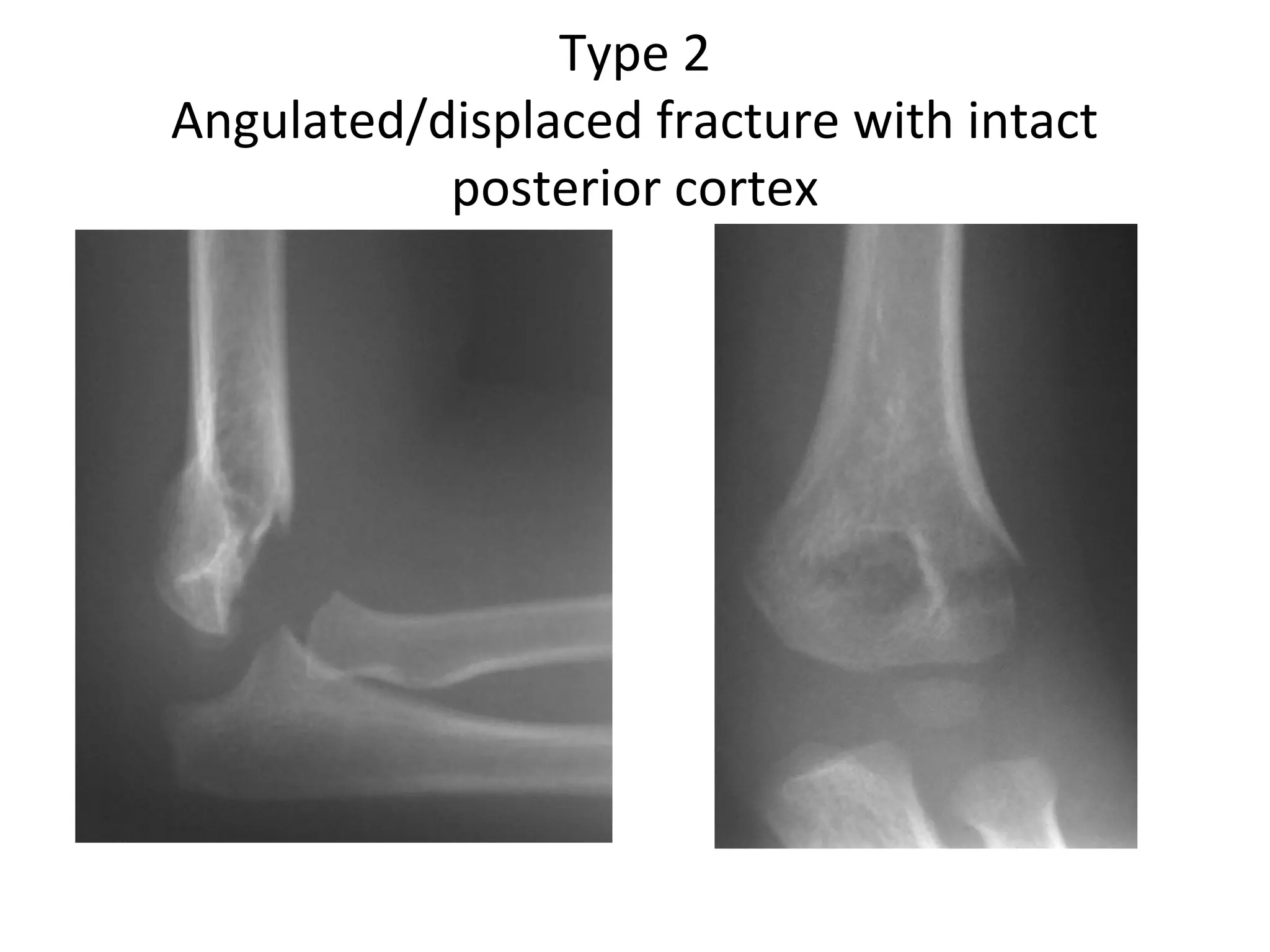 Classificaton-of-injuries-around-elbow-management-of-supracondylar ...