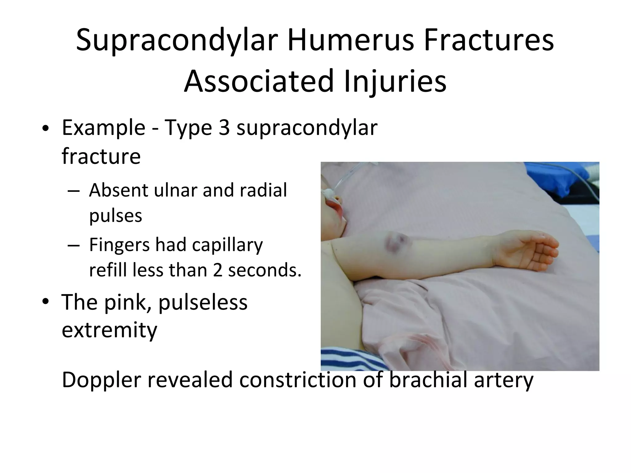Classificaton-of-injuries-around-elbow-management-of-supracondylar ...