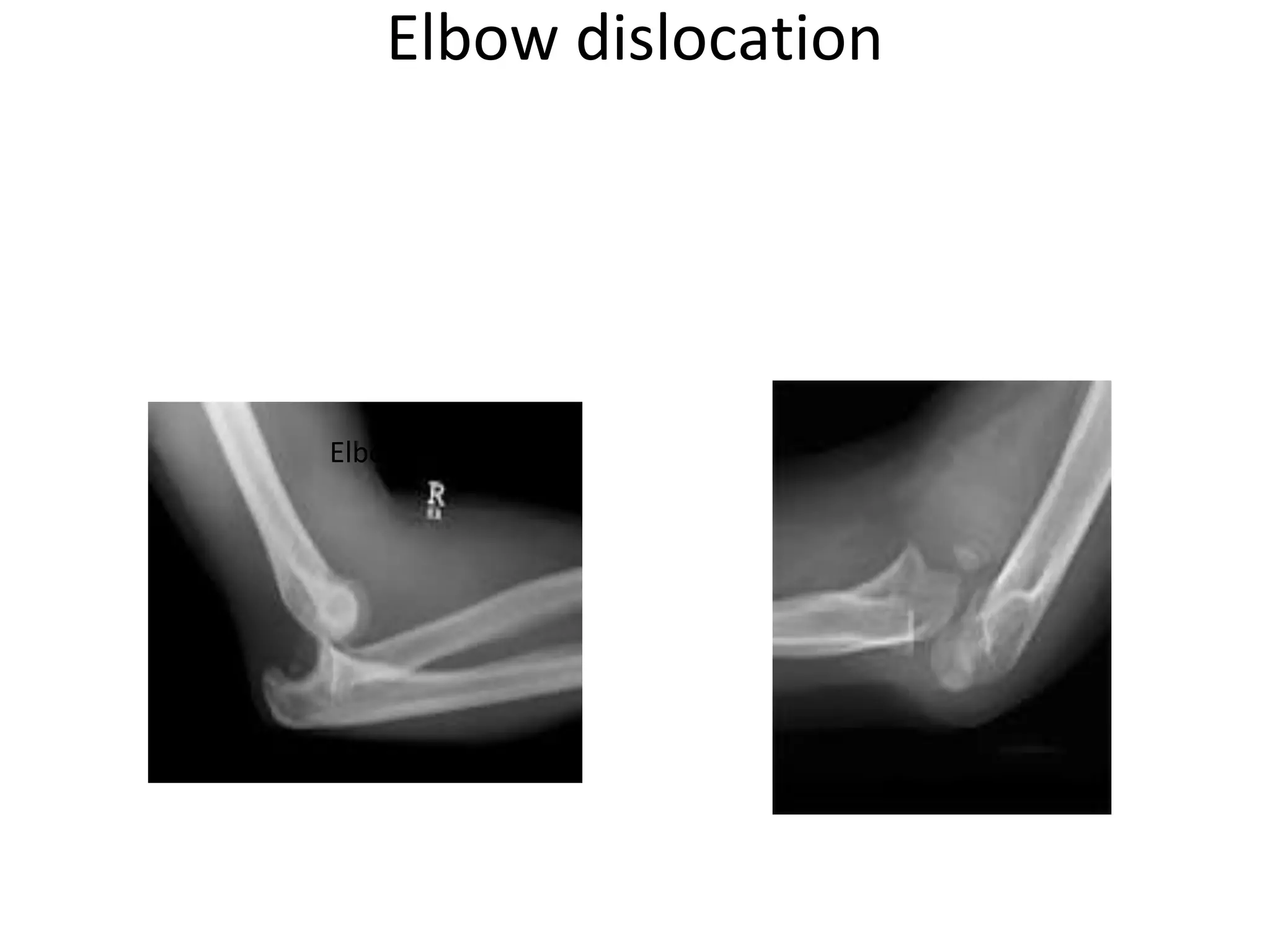 Classificaton-of-injuries-around-elbow-management-of-supracondylar-fracture-dislocation-of-elbow ...
