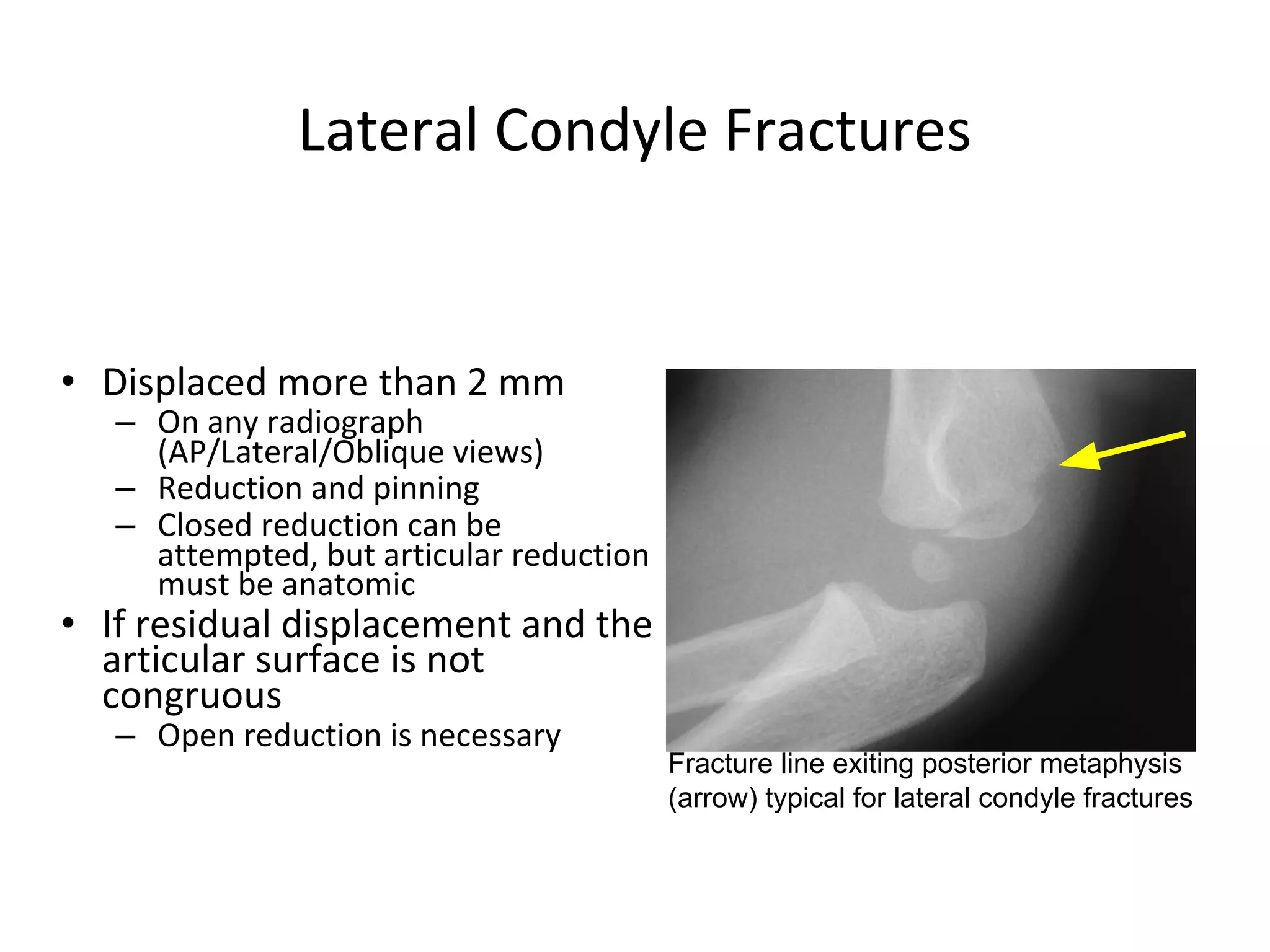 Classificaton-of-injuries-around-elbow-management-of-supracondylar ...