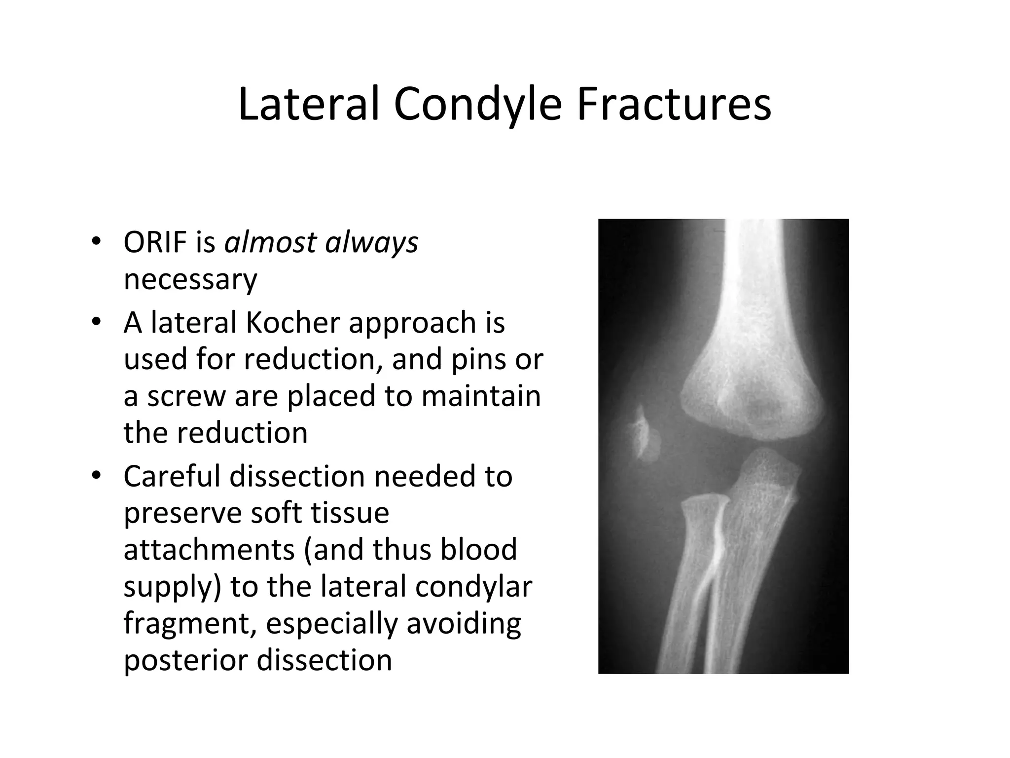 Classificaton-of-injuries-around-elbow-management-of-supracondylar ...