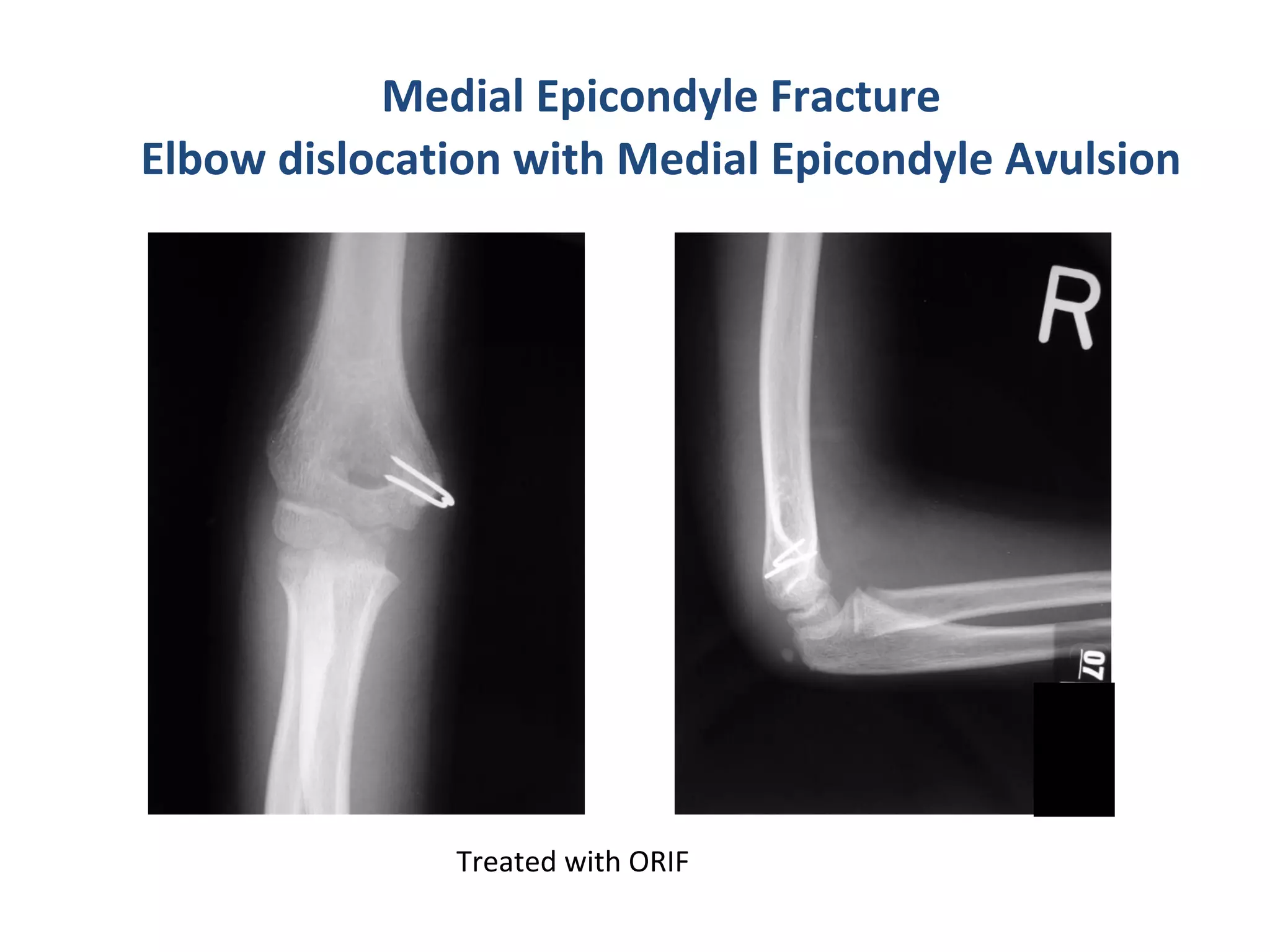 Classificaton-of-injuries-around-elbow-management-of-supracondylar ...