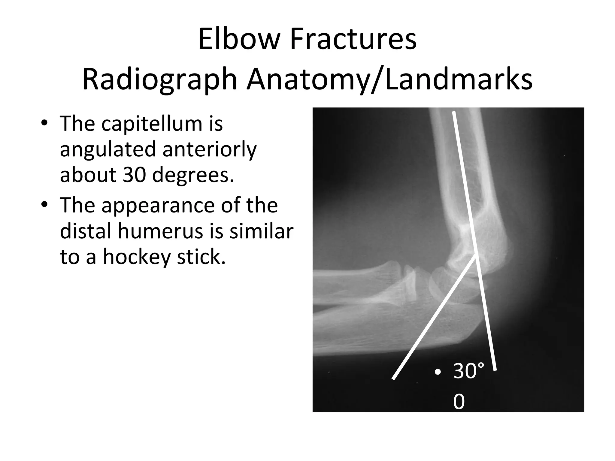 Classificaton-of-injuries-around-elbow-management-of-supracondylar ...