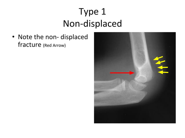 Classificaton-of-injuries-around-elbow-management-of-supracondylar ...