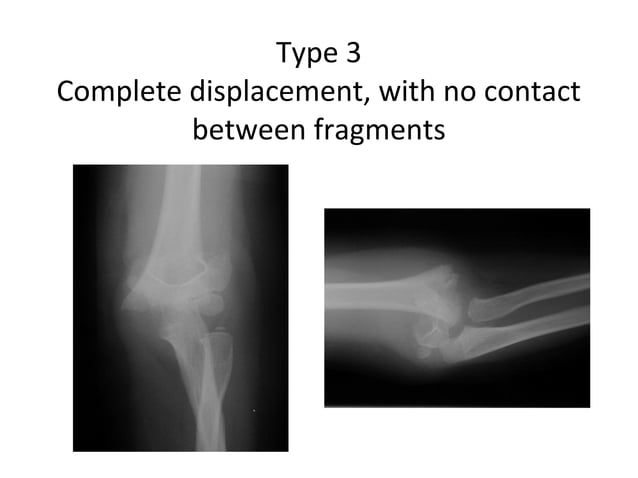 Classificaton-of-injuries-around-elbow-management-of-supracondylar ...