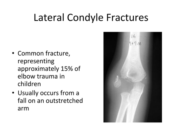 Classificaton-of-injuries-around-elbow-management-of-supracondylar ...