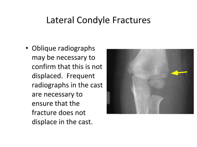 Classificaton-of-injuries-around-elbow-management-of-supracondylar ...