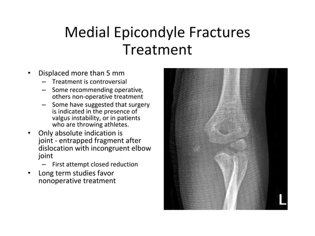 Classificaton-of-injuries-around-elbow-management-of-supracondylar ...