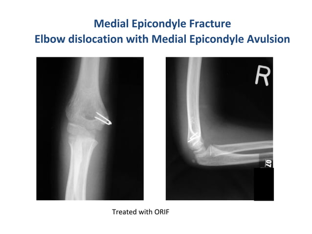 Classificaton-of-injuries-around-elbow-management-of-supracondylar ...