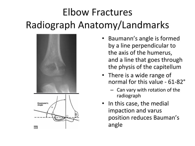 Classificaton-of-injuries-around-elbow-management-of-supracondylar ...