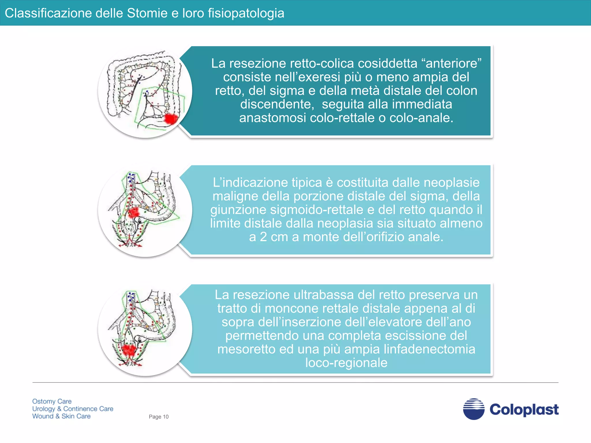 Classificazione delle stomie e loro fisiopatologia - Corso Stomaterapia ...
