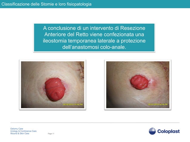Classificazione delle stomie e loro fisiopatologia - Corso Stomaterapia di base - Firenze 8-9.05 ...