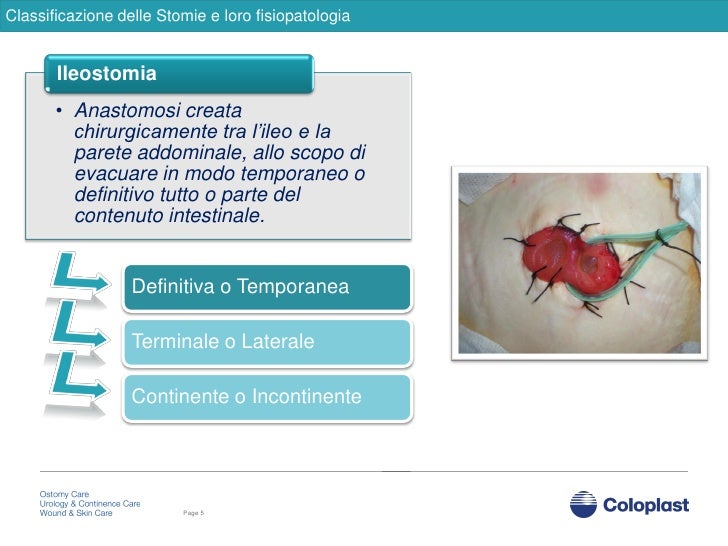 Classificazione delle stomie e loro fisiopatologia - Corso Stomaterap…