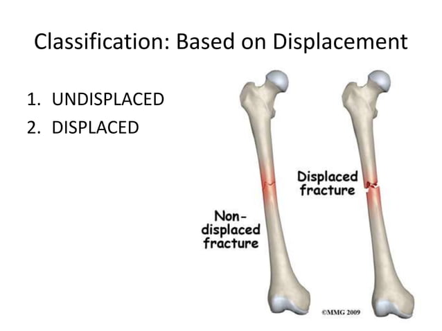 Classification of Fractures & Compound Fracture Managment | PPTX