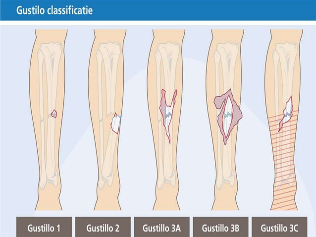 Classification of Fractures & Compound Fracture Managment | PPTX