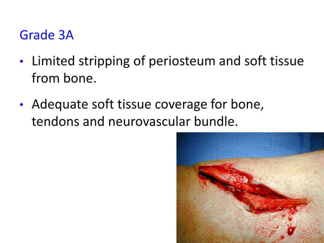 Classification of Fractures & Compound Fracture Managment | PPTX