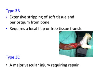 Classification of Fractures & Compound Fracture Managment | PPTX