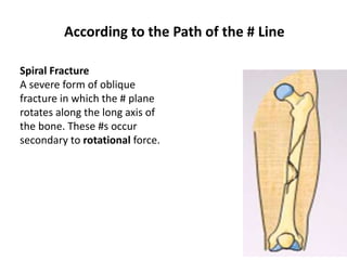 Compound Fractures Open Fractures Symptoms,, 50% OFF