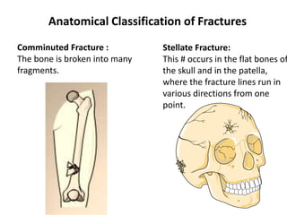 Classification of Fractures & Compound Fracture Managment | PPT