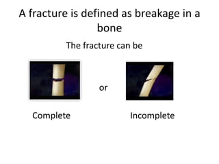 Classifying fractures | PPTX