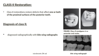 Class II Composite and Amalgam Preperation | PPTX