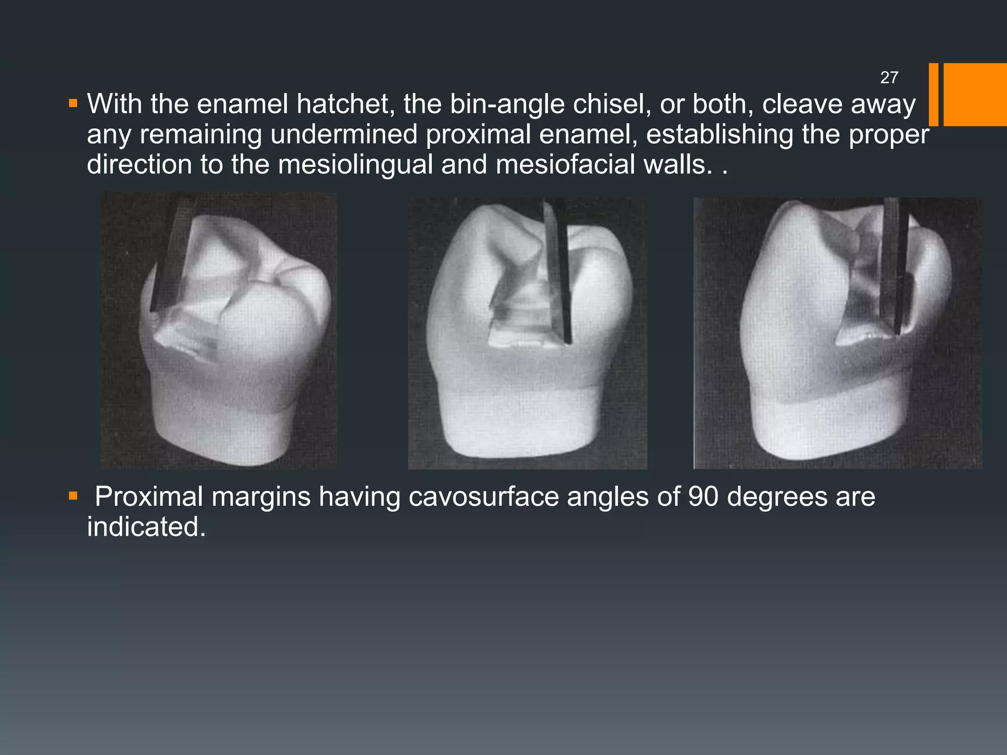 Class ii amalgam | PPTX