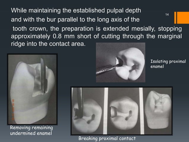 Class ii amalgam | PPTX | Dental Health | Diseases and Conditions